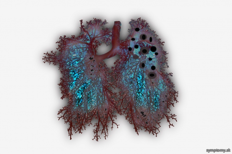 Tuberkulóza - príznaky a liečba